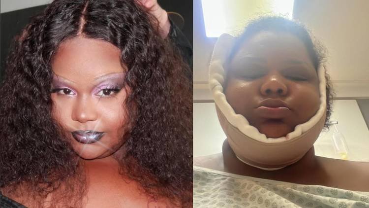 MC Carol exibe resultado da lipo de papada após perder 70 kg; veja as ...